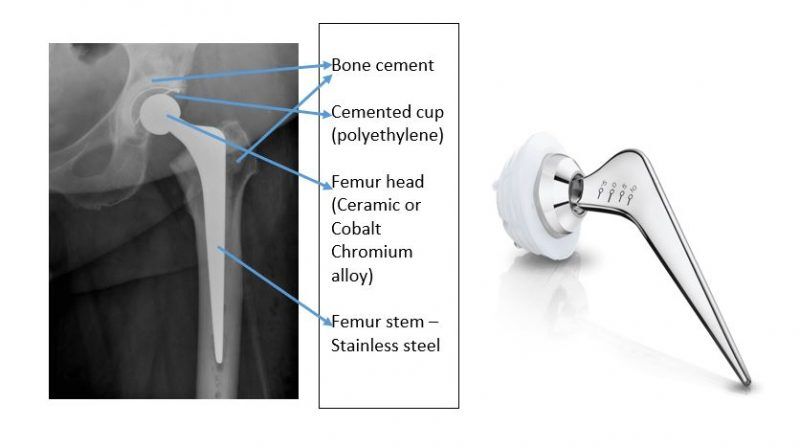 Total Hip Replacement surgery Tunbridge Wells | Crowborough
