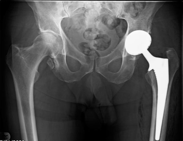 Mini Hip Replacement in Tunbridge Wells, Kent | Crowborough